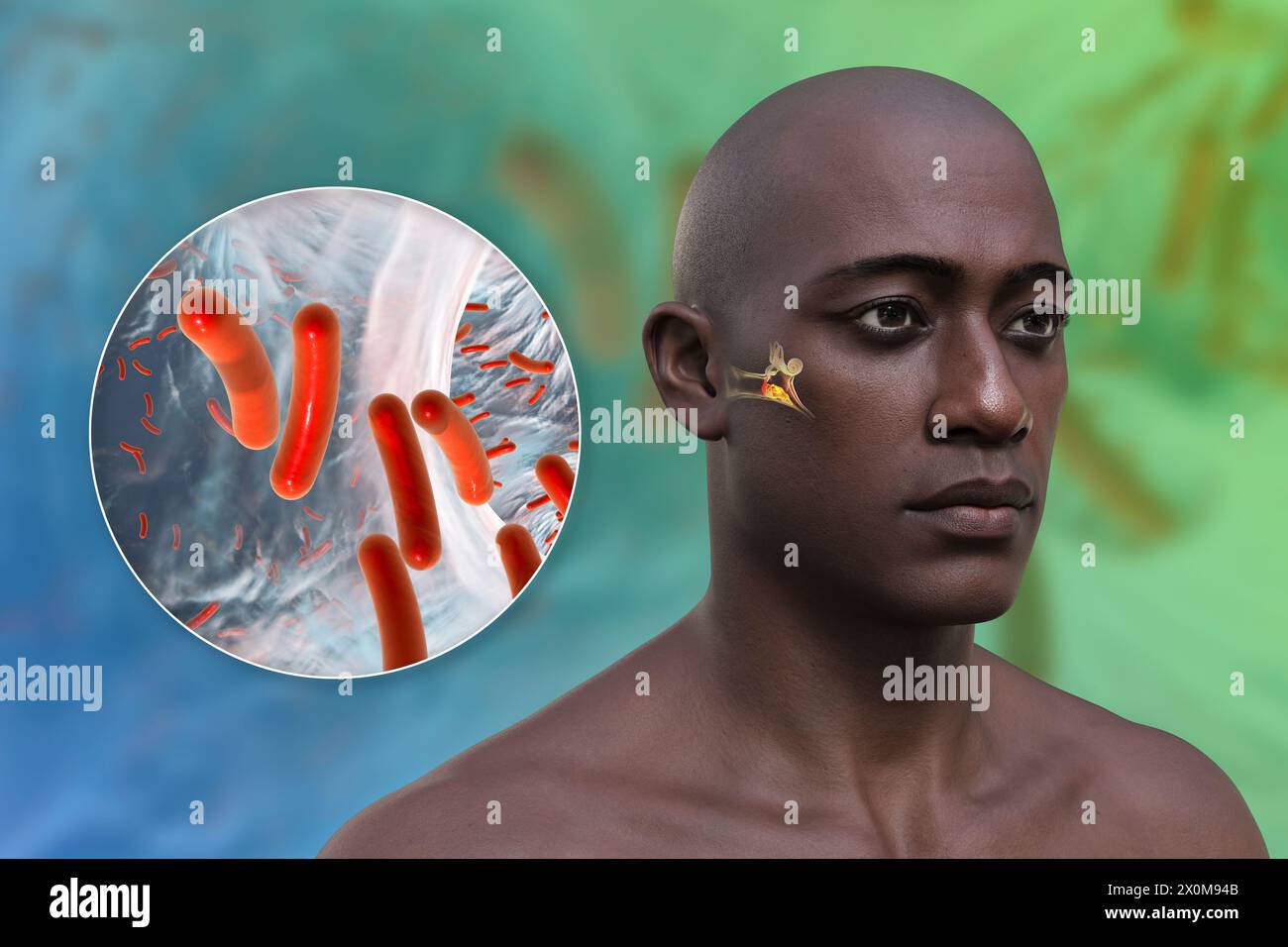 3D illustration of a man with a bacterial infection of the middle ear ...
