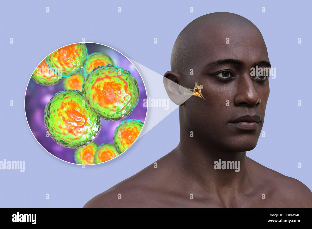 3D illustration of a man with an infection of the middle ear (otitis ...