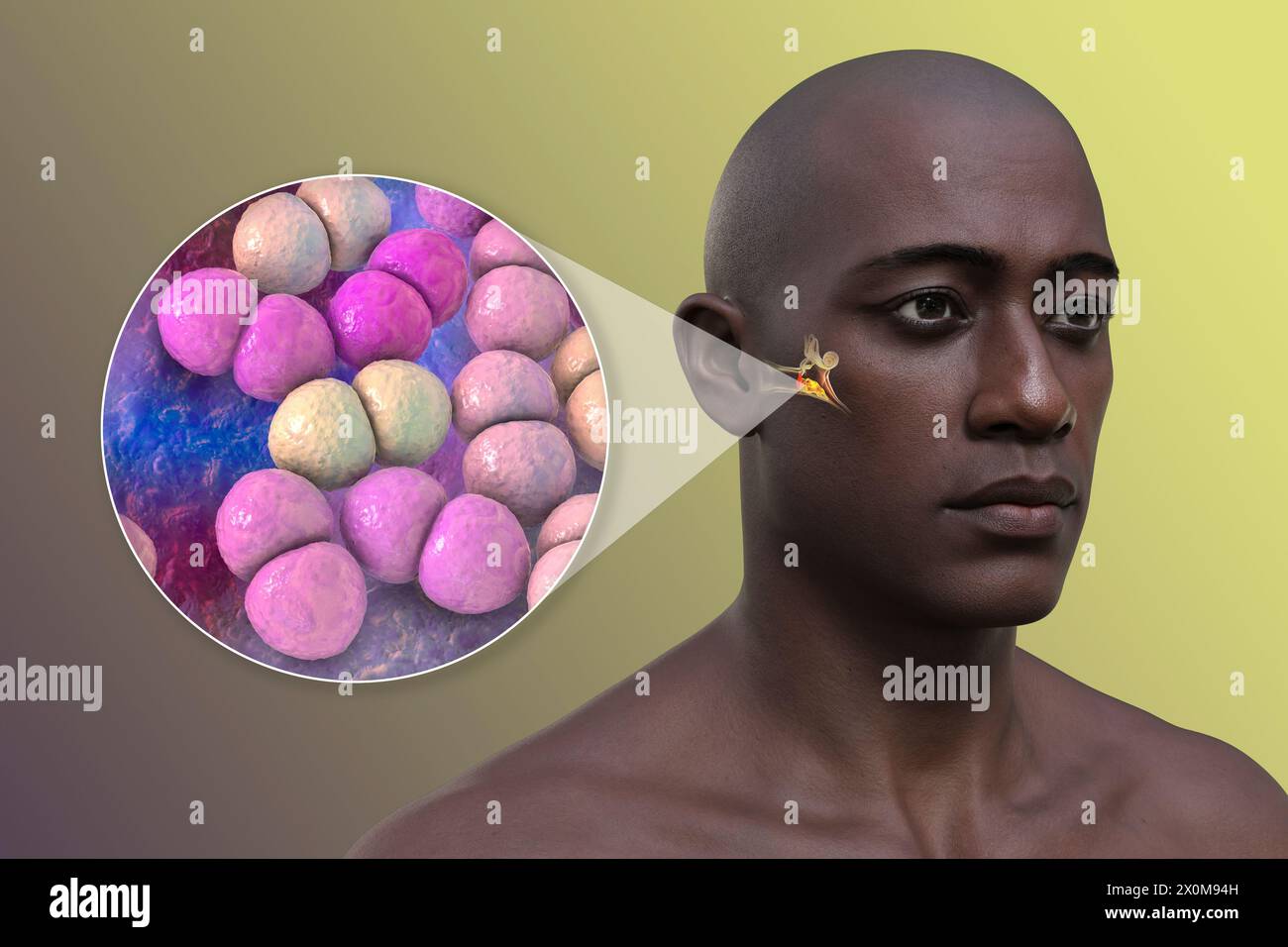 3D illustration of a man with a bacterial infection of the middle ear ...