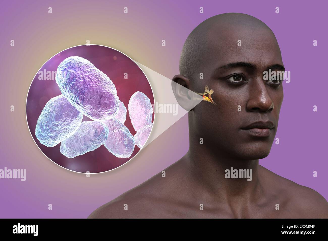 3D illustration of a man with an infection of the middle ear (otitis ...