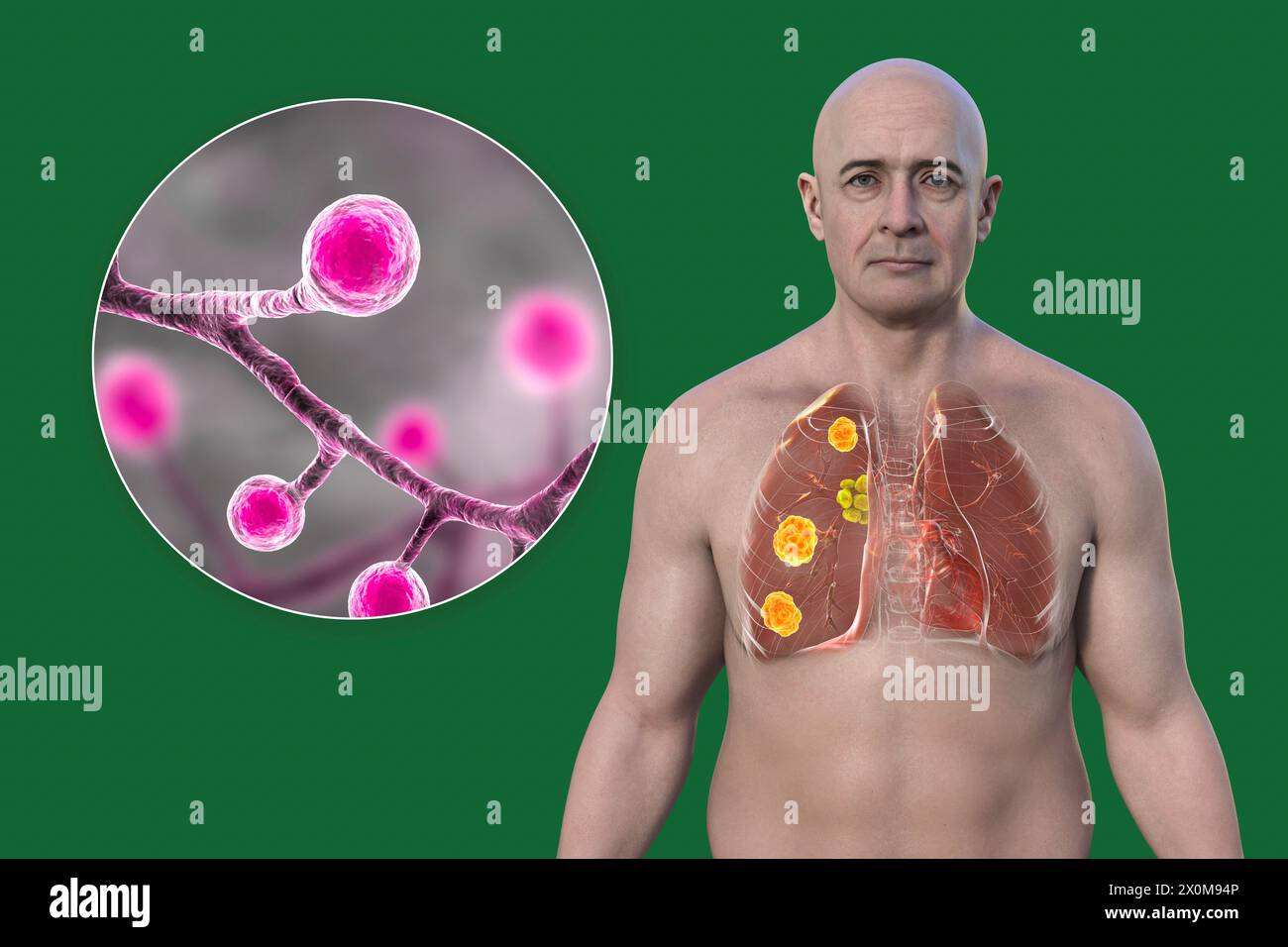 3D illustration of pulmonary blastomycosis, and a close-up of the ...