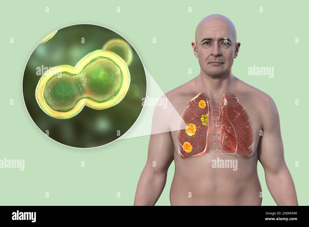 3D illustration of pulmonary blastomycosis, and a close-up of the ...