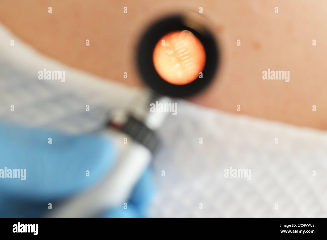 a dermatologist examines moles and skin growths on the patient's body ...