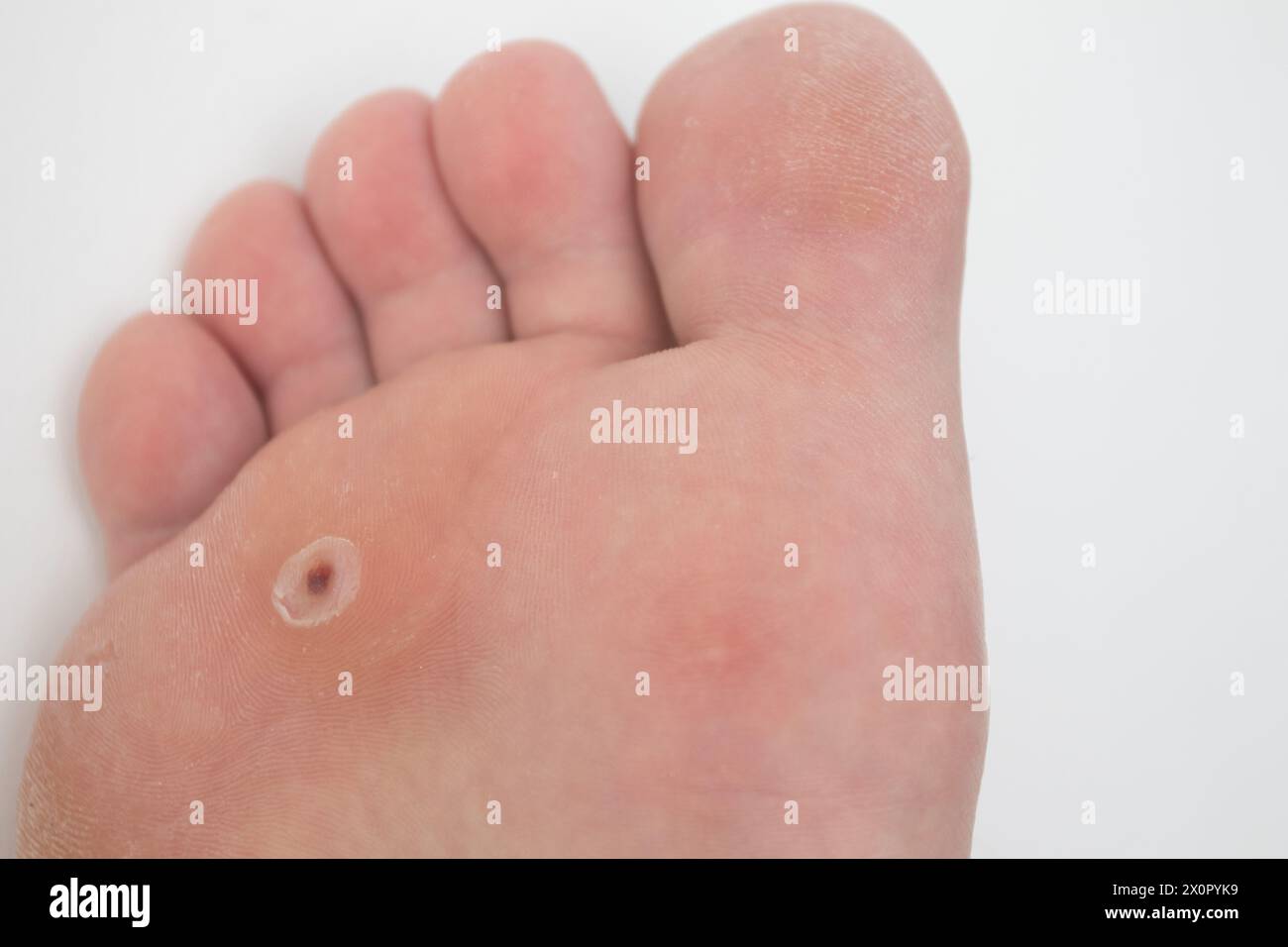 Foot with wart on a toe. Wart verrucas plantar Stock Photo - Alamy