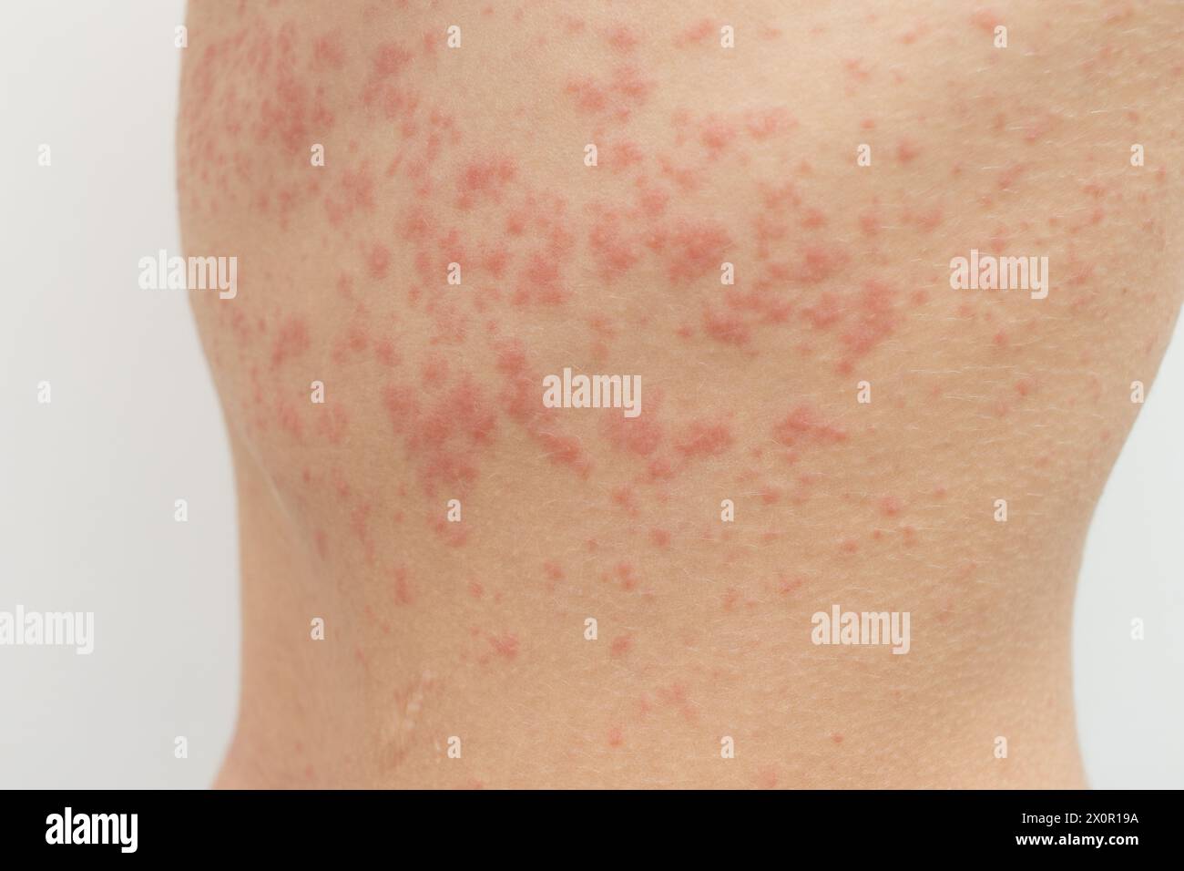 acute Urticaria allergy Stock Photo - Alamy