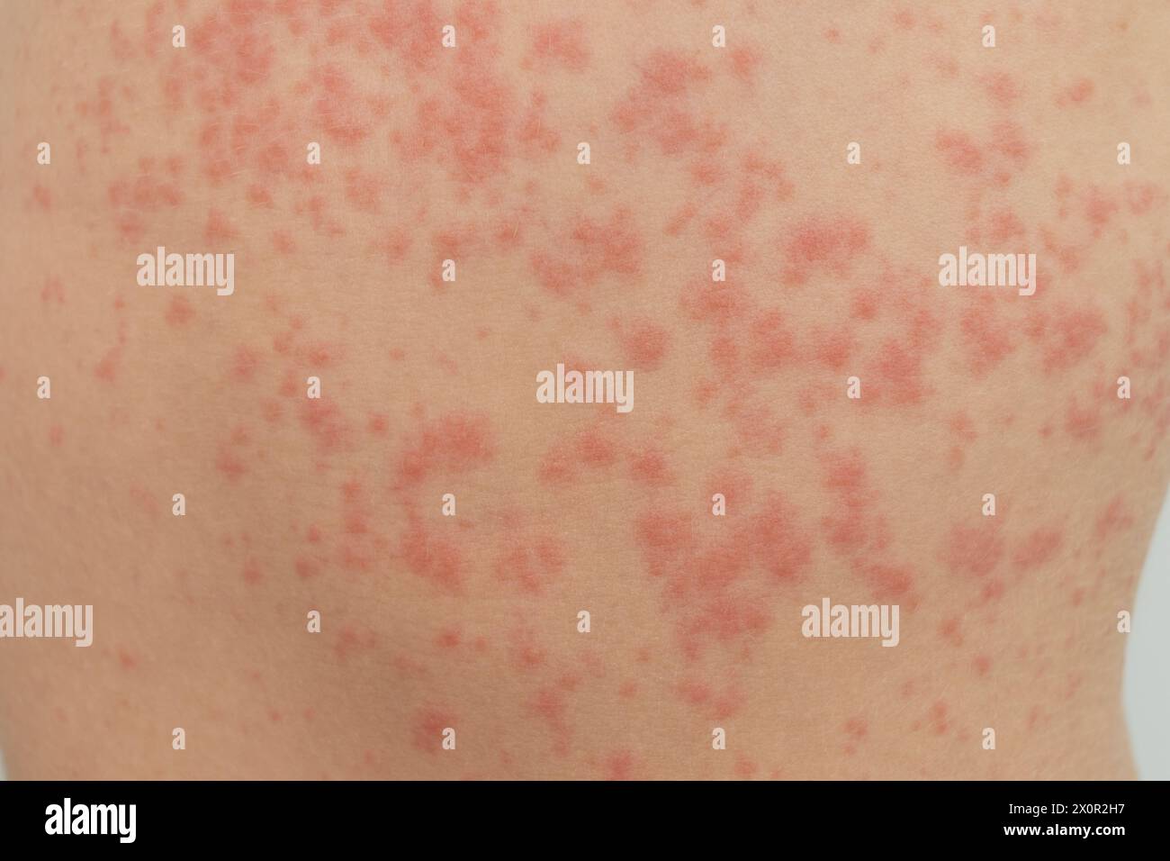 Urticaria is an allergic reaction on the skin. Red spots on the skin ...