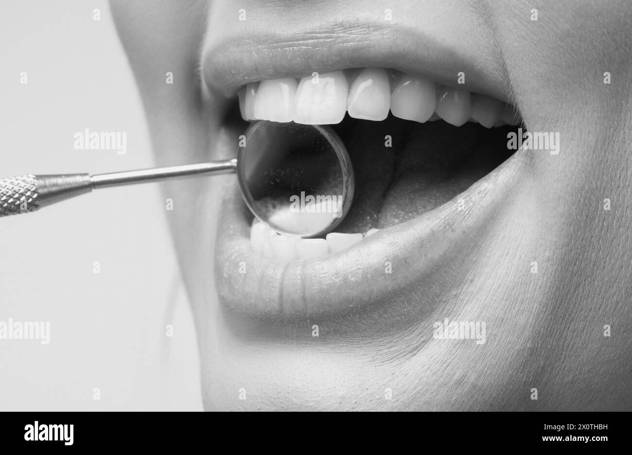 Teeth mirror close-up. Examination of teeth with dental mirror. Tooth ...