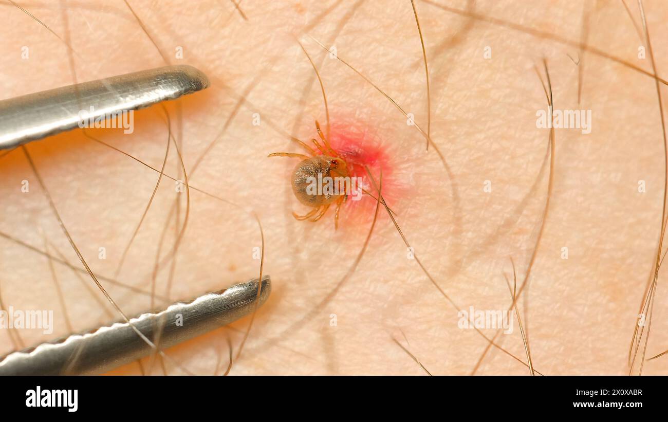 Close-up of tick embedded in human skin being removed with tweezers ...