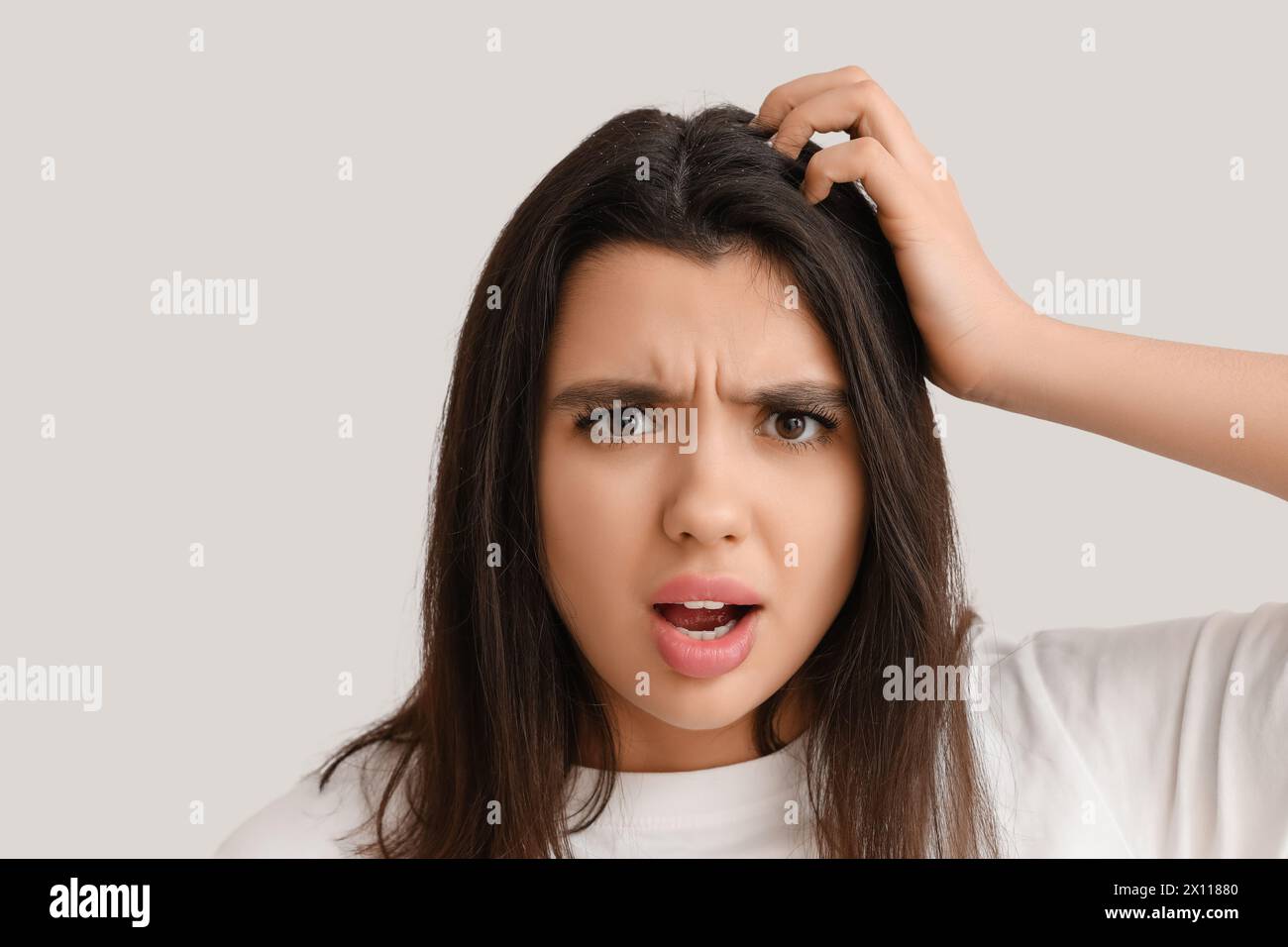 Stressed young woman with dandruff problem scratching head on white ...