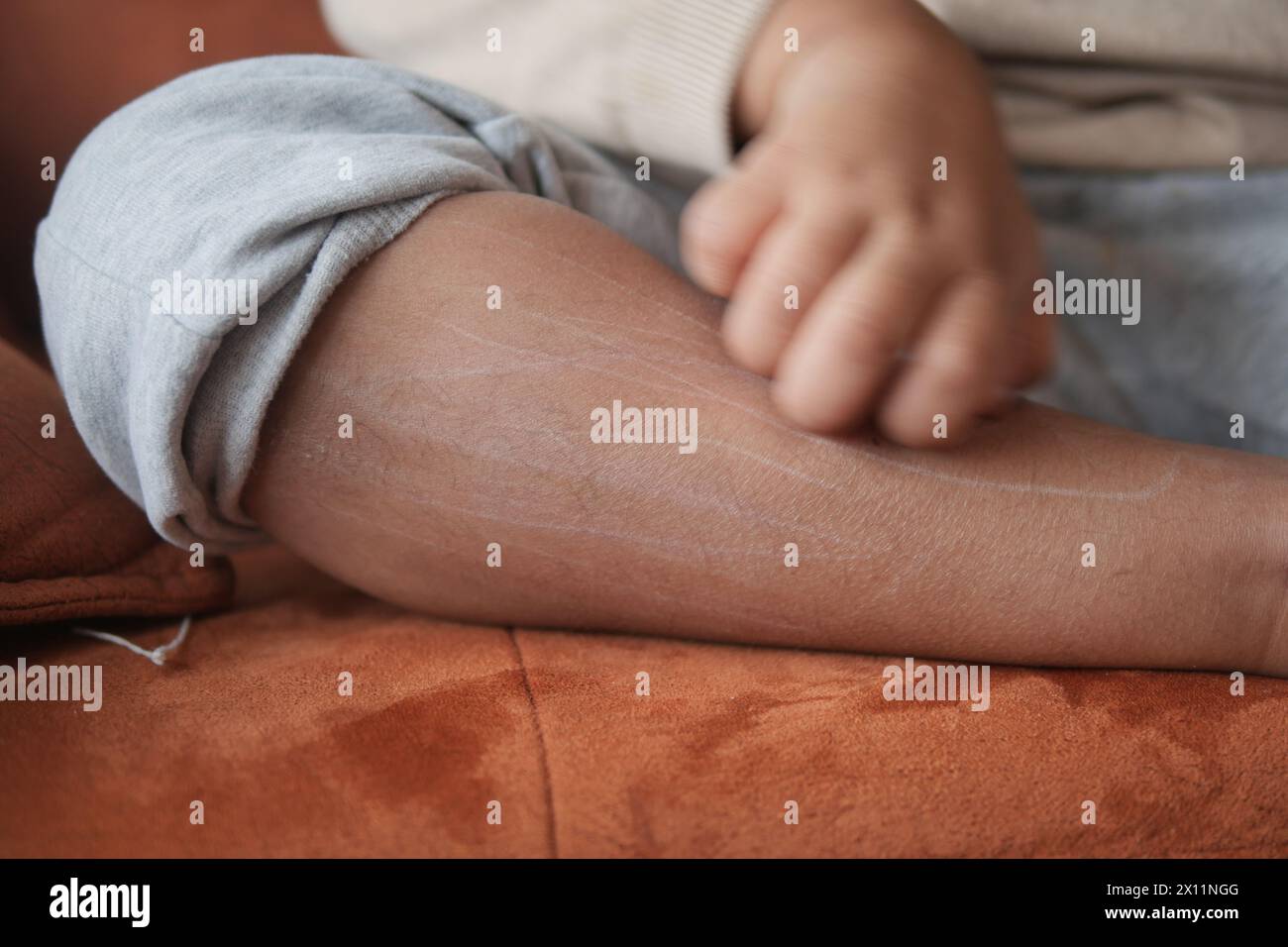 a kid suffering from itching skin on feet Stock Photo - Alamy