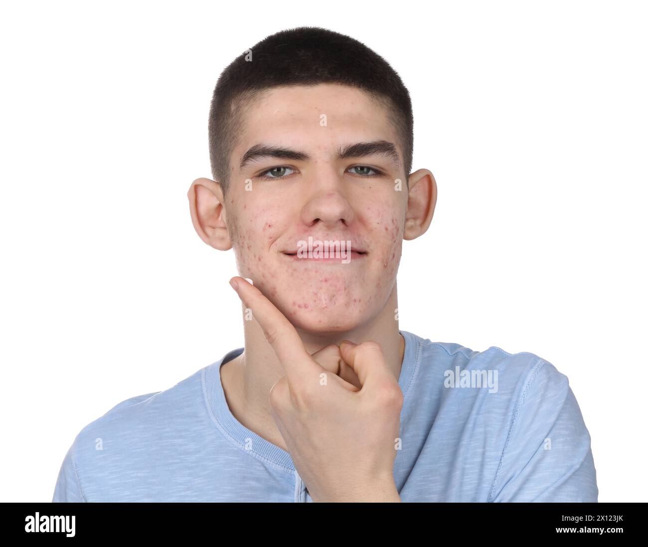 Young man with acne problem applying cosmetic product onto his skin on ...