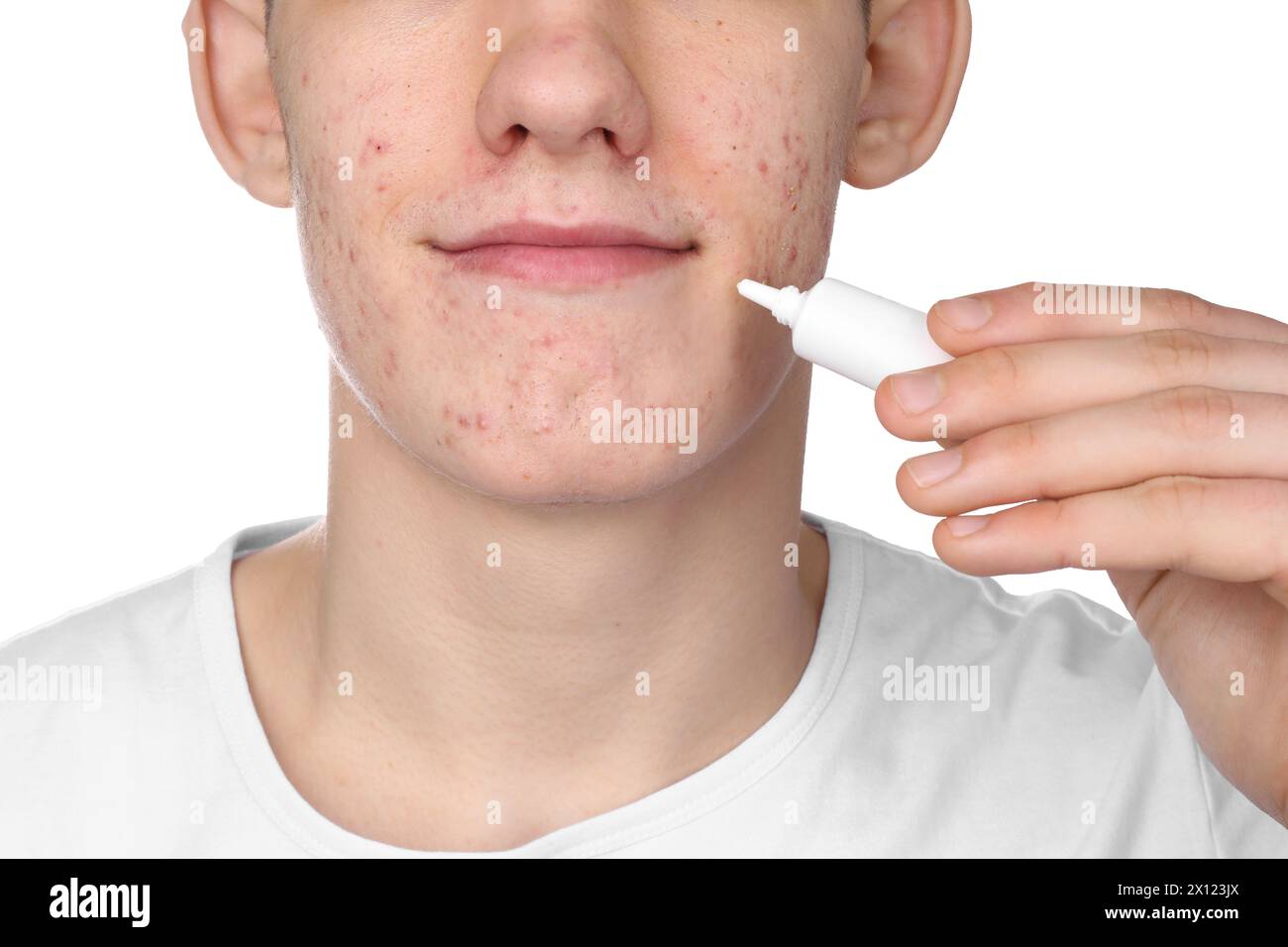 Young man with acne problem applying cosmetic product onto his skin on ...