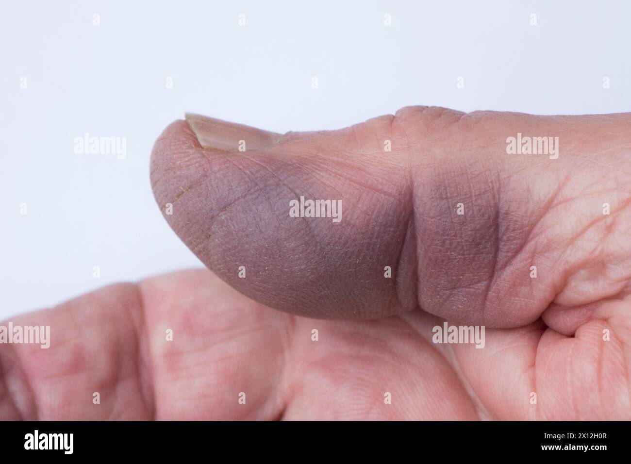 black bruised thumb due to Achenbach syndrome, subcutaneous bruise, man ...
