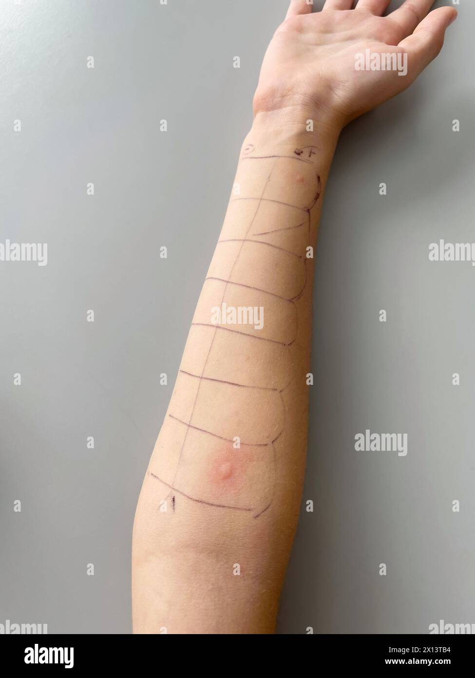 Prick test for inhalant allergies with positive reaction to histamine ...