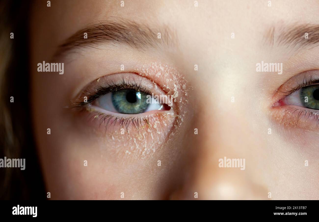 Eye of a little girl suffering from ocular atopic dermatitis or eyelid ...