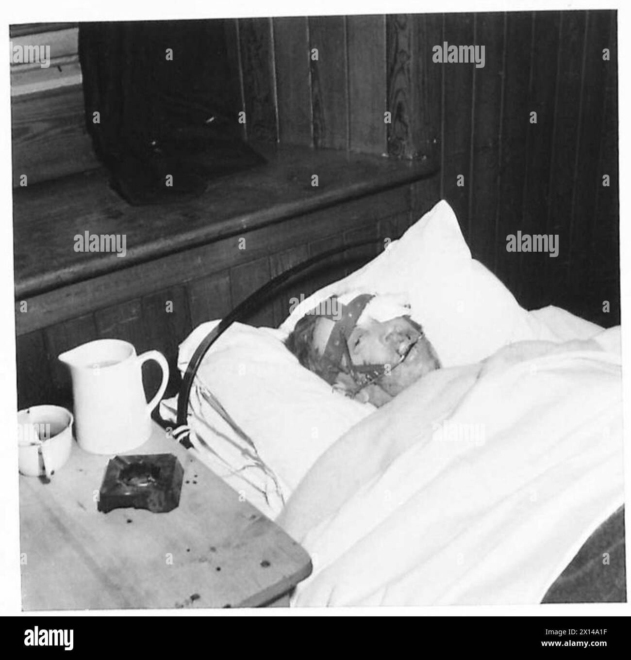 A soldier is documented with a compound head fracture, including a ...