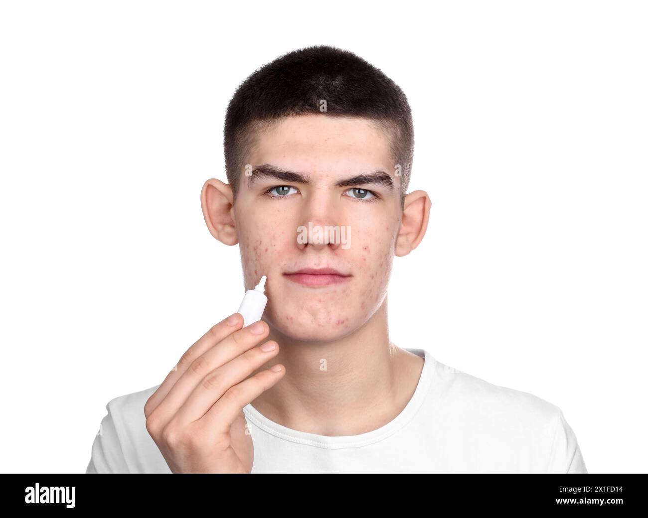 Young man with acne problem applying cosmetic product onto his skin on ...