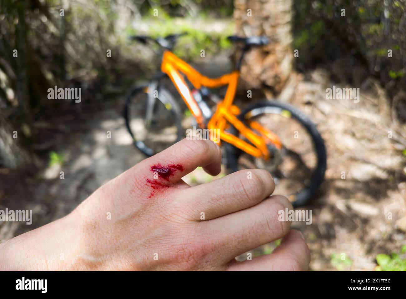 Bloody arm stump hi-res stock photography and images - Alamy