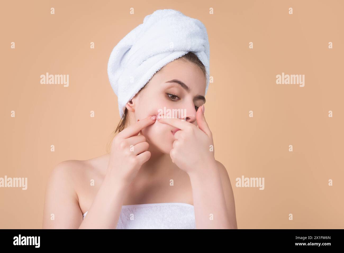 Close up Woman squeeze out pimples on cheek. Acne and pimple on skin ...