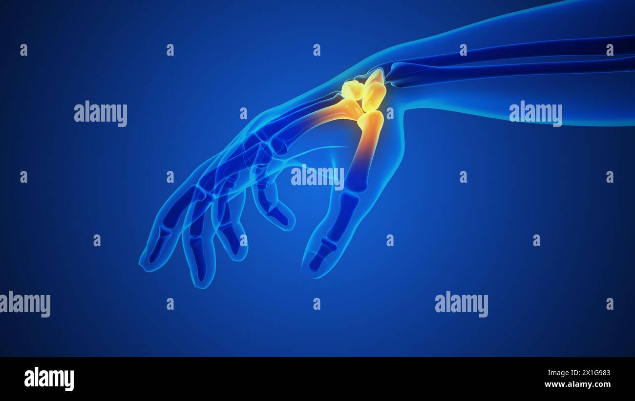 Arthritis of the finger and thumb joint Stock Photo - Alamy