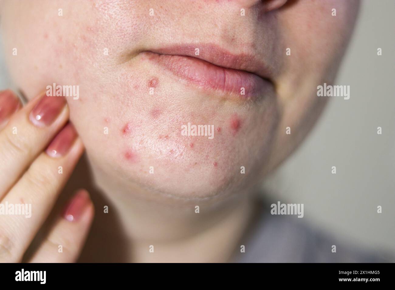 Close up of female face with red problematic acne skin, blurry ...