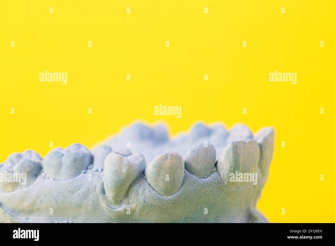 Blue plaster model of an impression of a patient's jaw at an ...