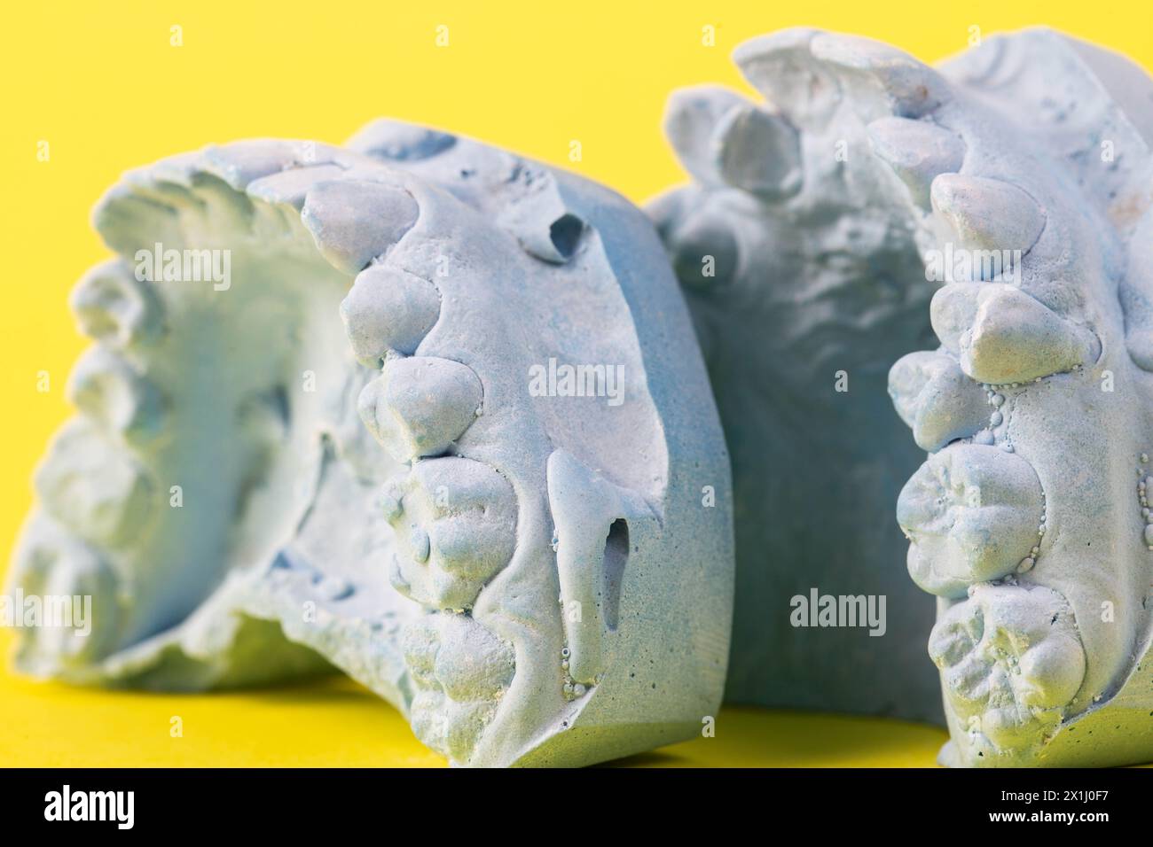 Blue plaster impression of a patient's dental jaw with crooked teeth ...