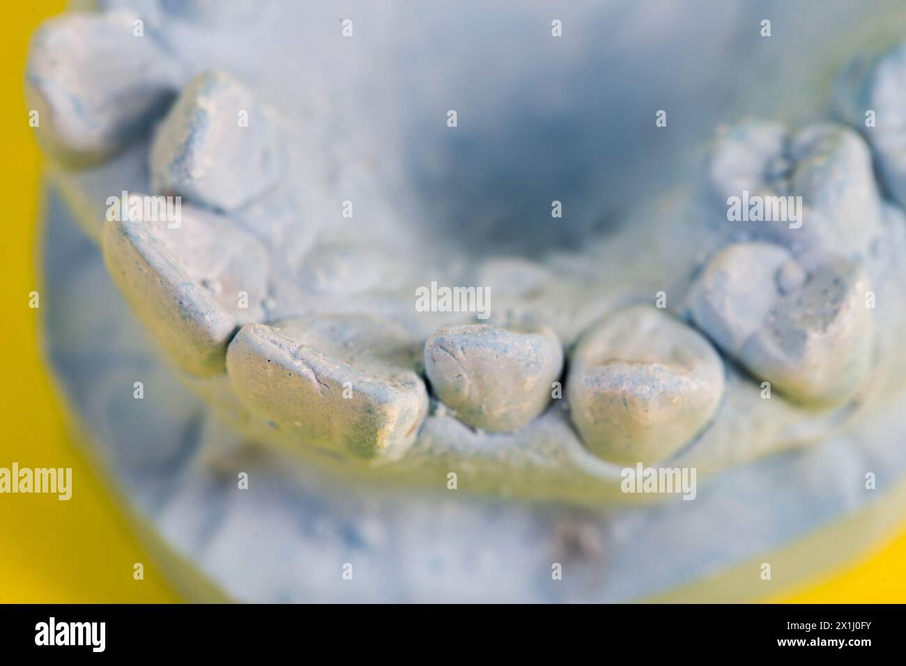 Blue plaster model of an impression of a patient s jaw at an ...