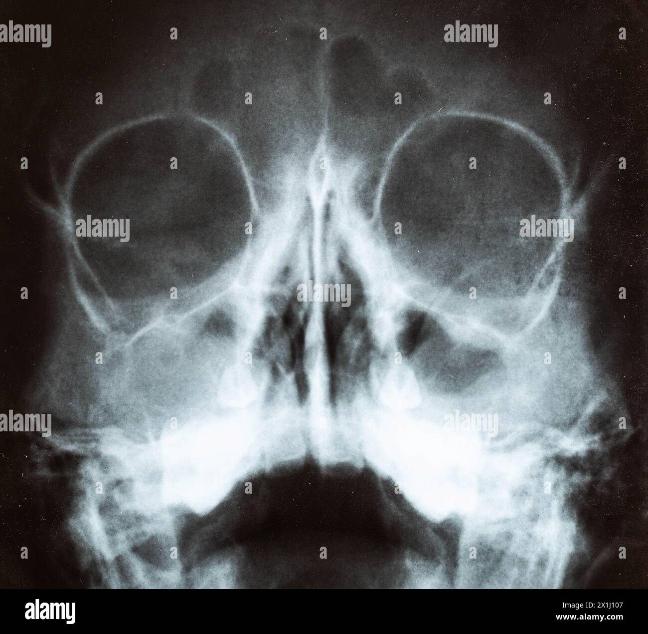X-ray image of the skull of a child with purulent sinusitis, close-up ...