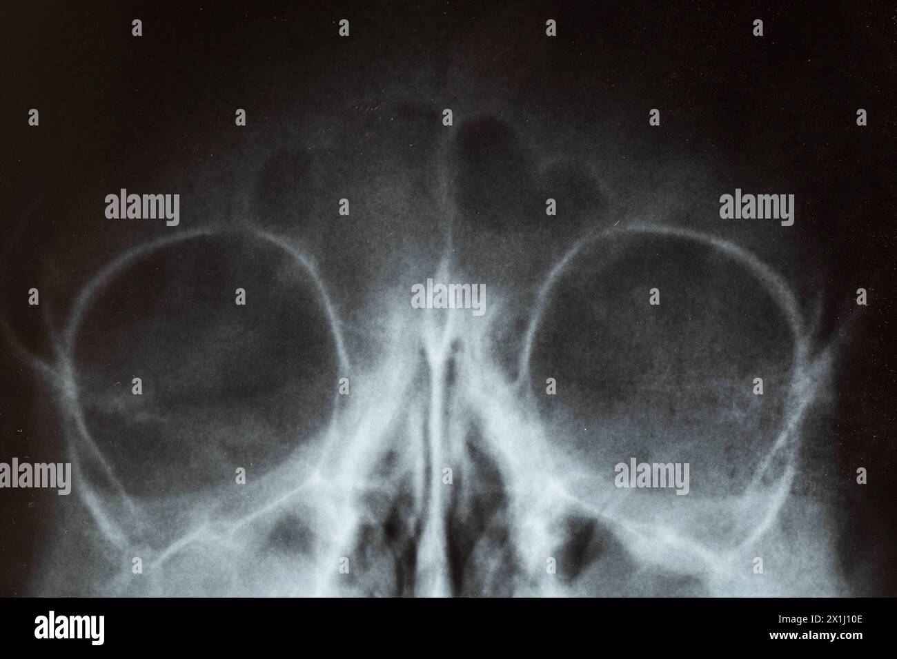 X-ray image of the skull of a child with purulent sinusitis, close-up ...