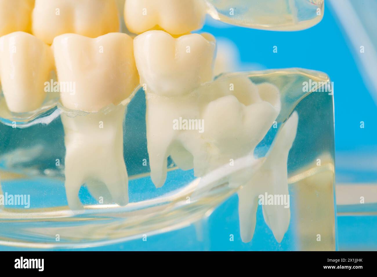 Dental cyst hi-res stock photography and images - Alamy