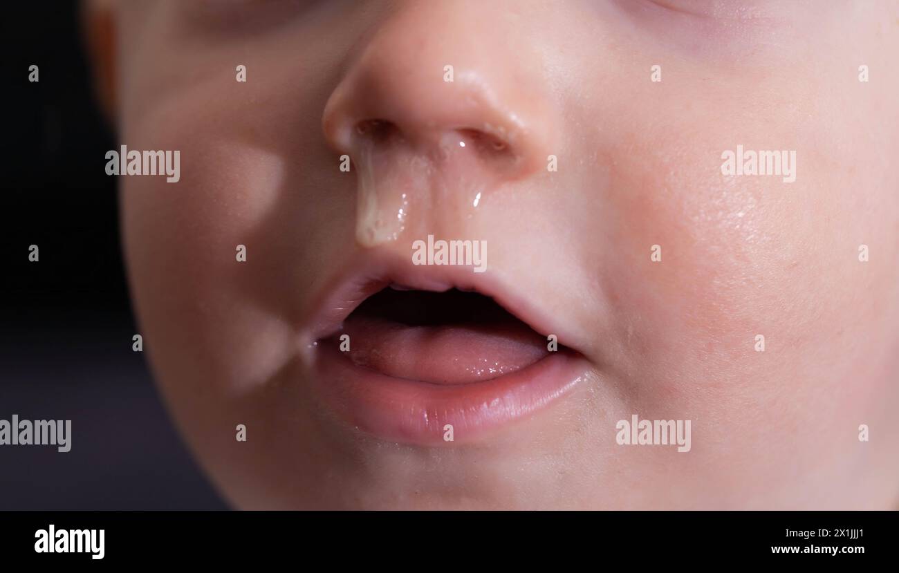 Chronic tonsillitis hi-res stock photography and images - Alamy