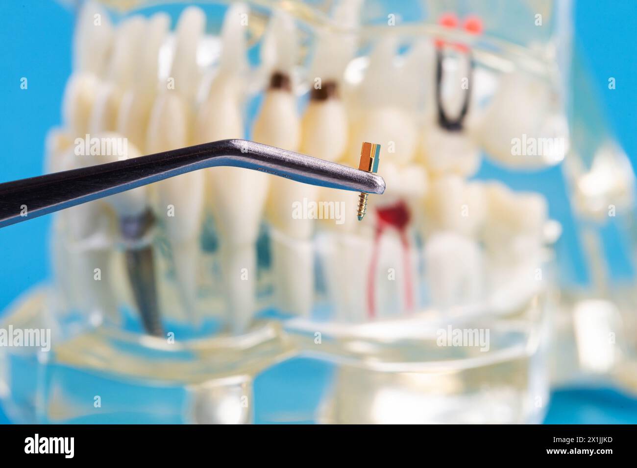 A dental metal pin in tweezers against the background of a medical ...