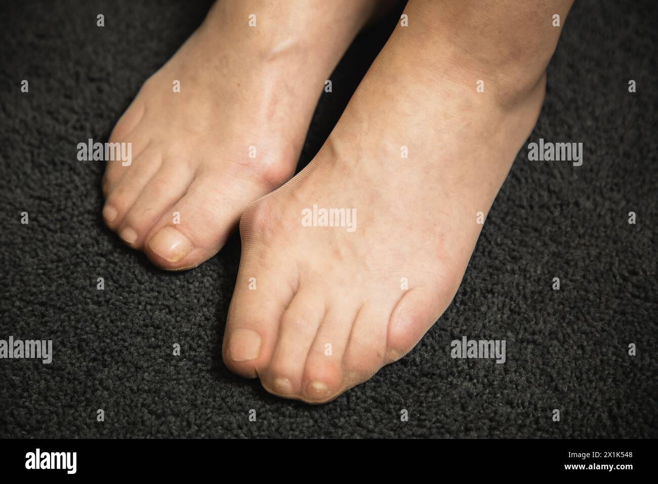 Flat feet and foot toe problems, What Problems Can Flat Feet Cause ...