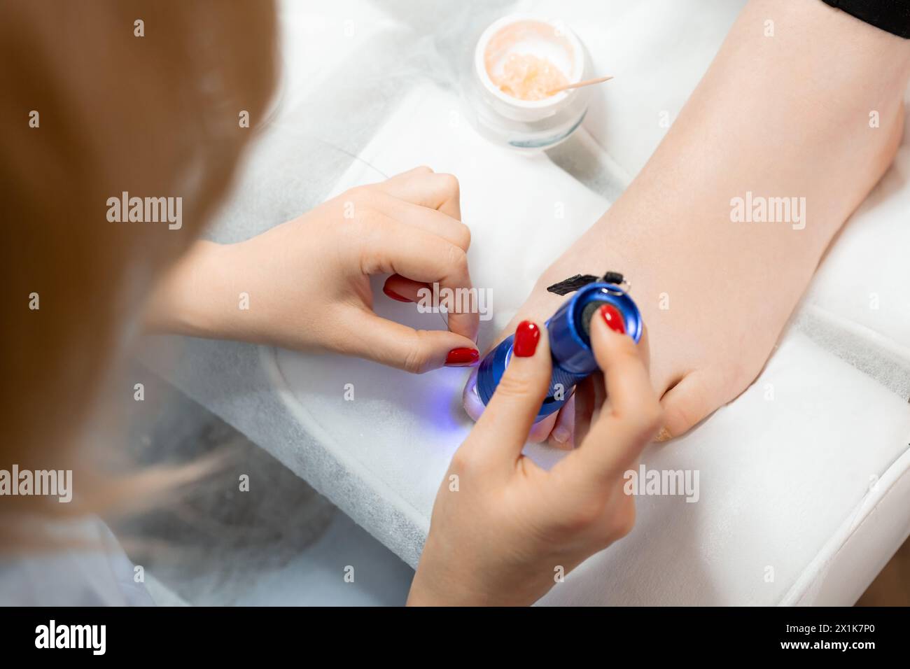 Podologist installs a titanium thread on the big toe using UV lamp for ...