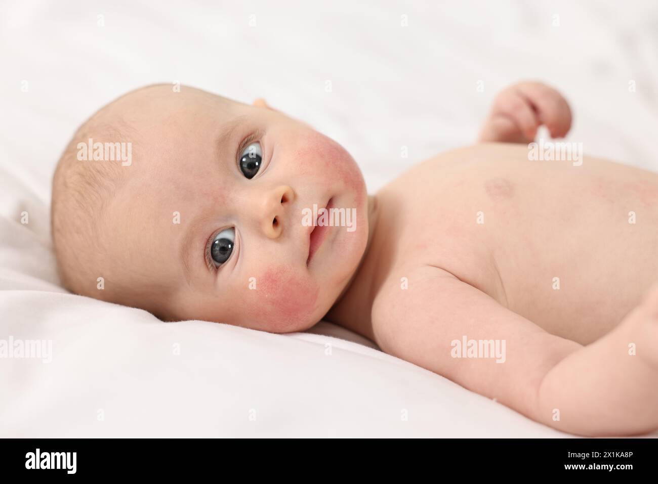 Cute little baby with allergic redness on cheeks lying on white blanket ...