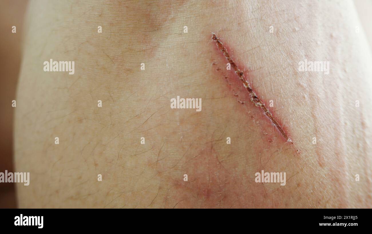 Scabs scab on knee hi-res stock photography and images - Alamy