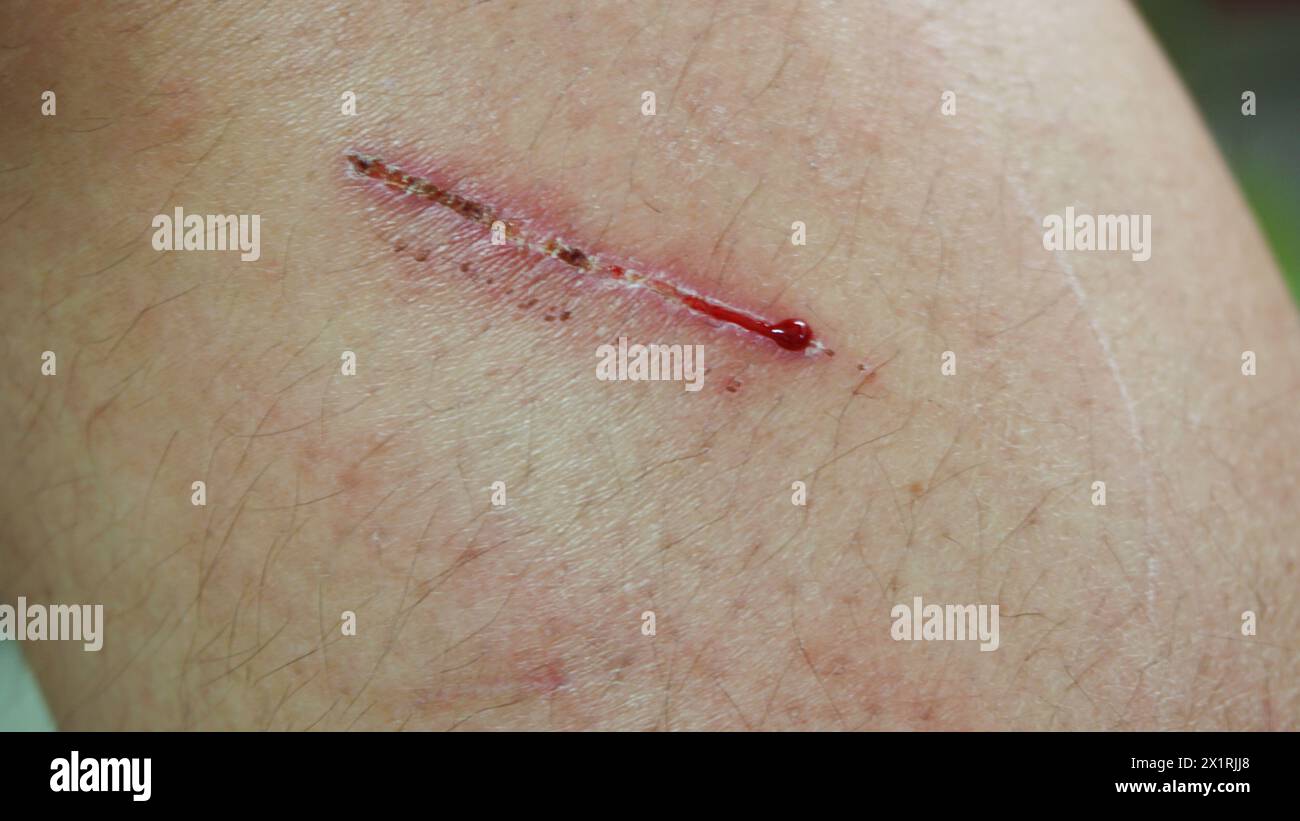 Wound with scabs on the knee of woman hi-res stock photography and ...