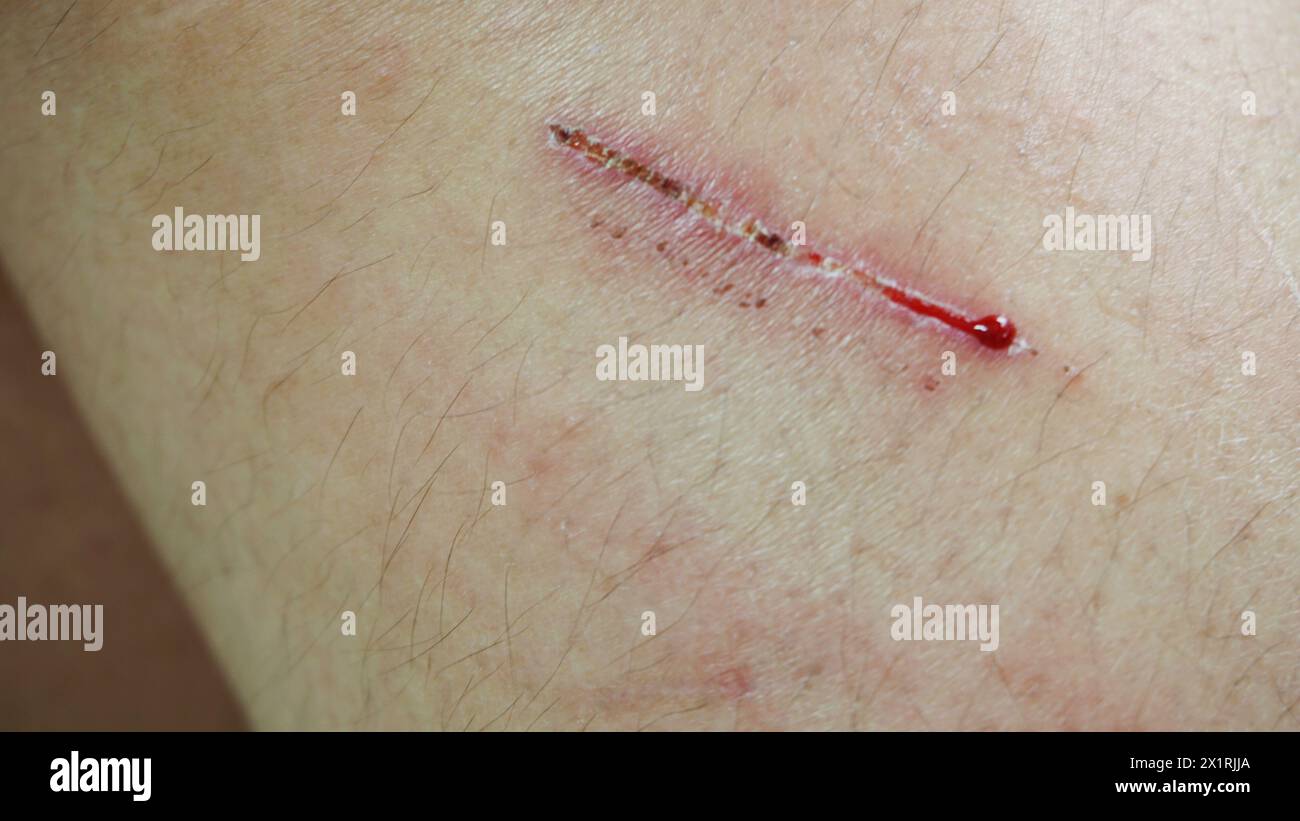 wound with scabs on the knee of woman Stock Photo - Alamy