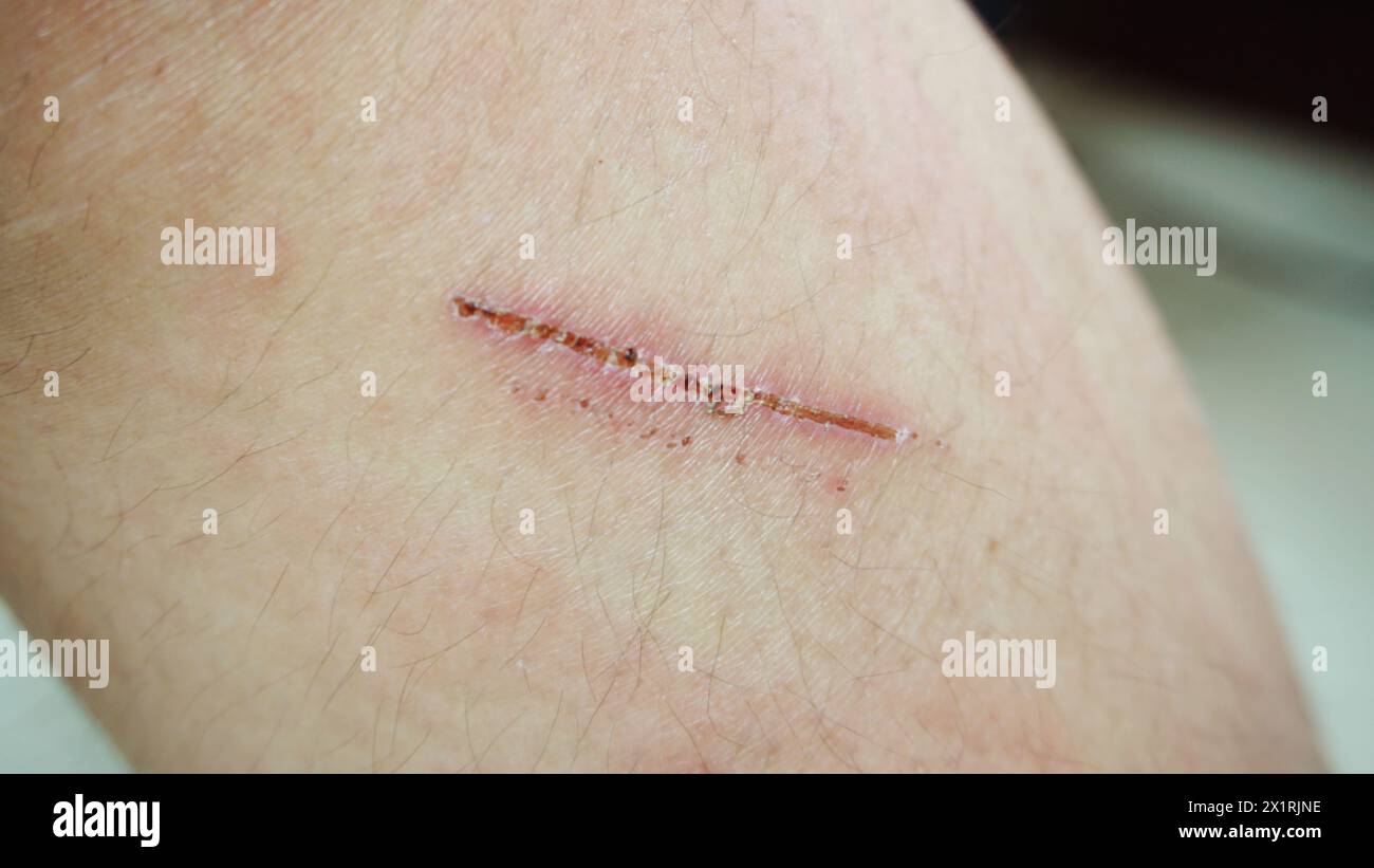 wound with scabs on the knee of woman Stock Photo - Alamy