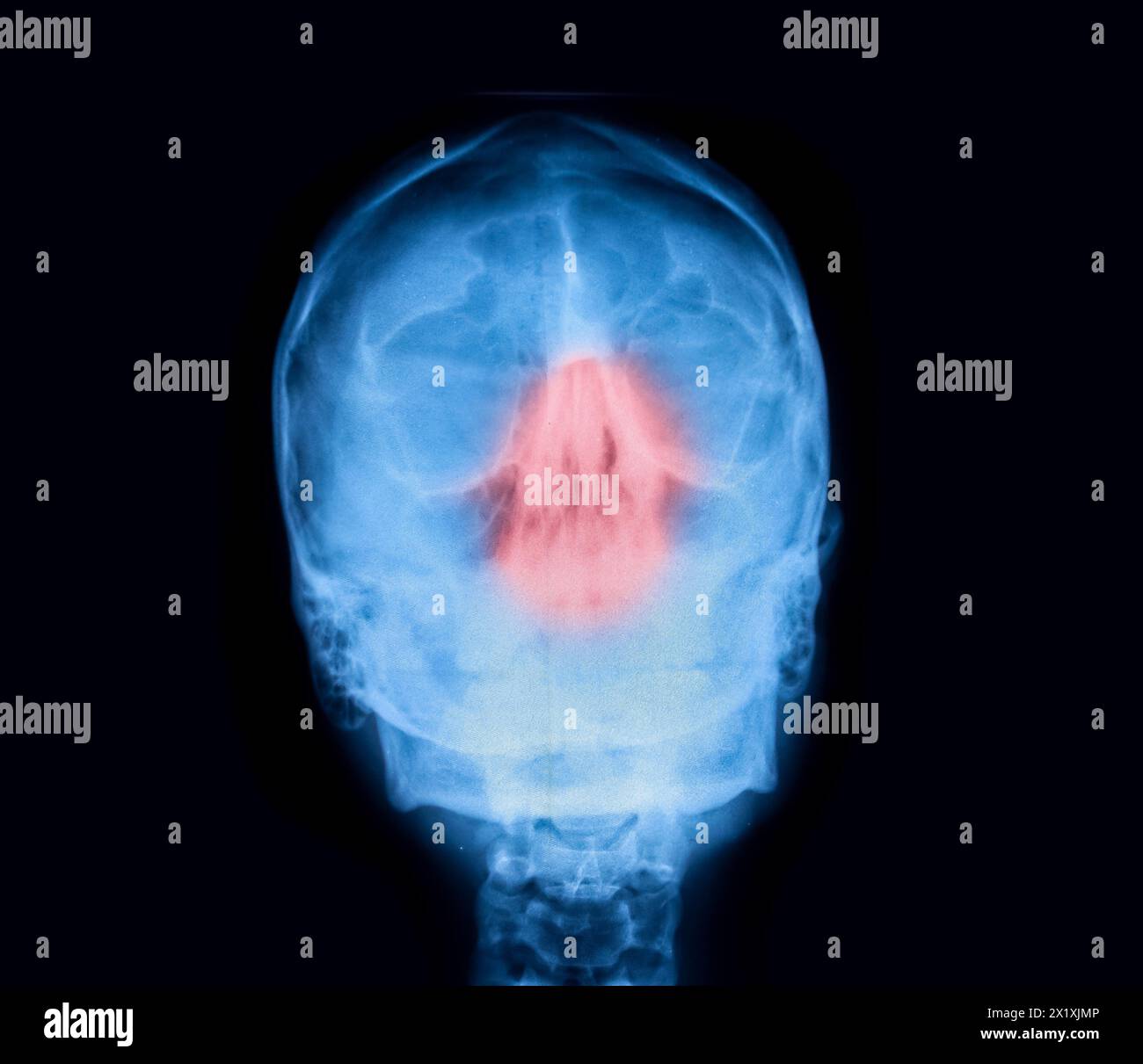 Radiography x-ray film of human skull and paranasal sinuses Stock Photo ...