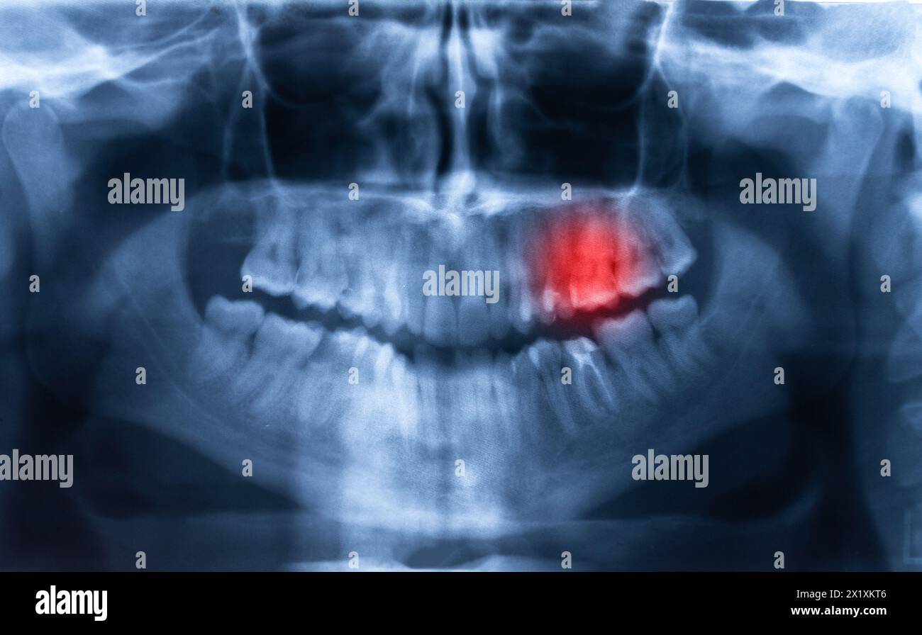 Close up teeth radiography scan hi-res stock photography and images - Alamy