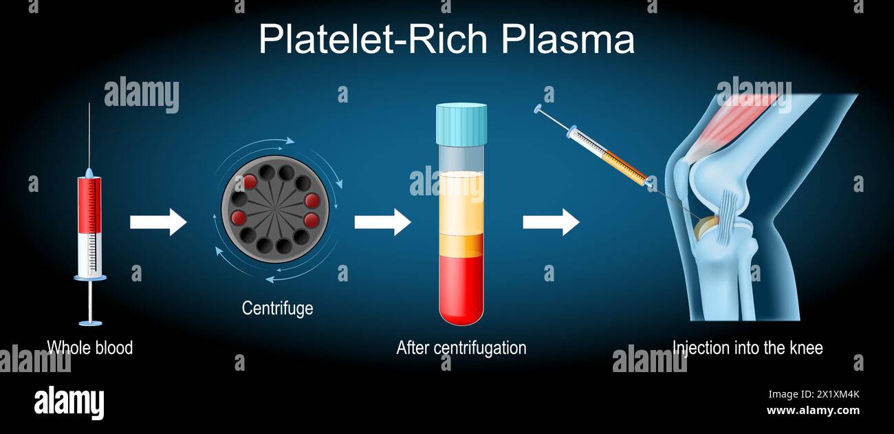 Platelet rich plasma injection knee hi-res stock photography and images - Alamy
