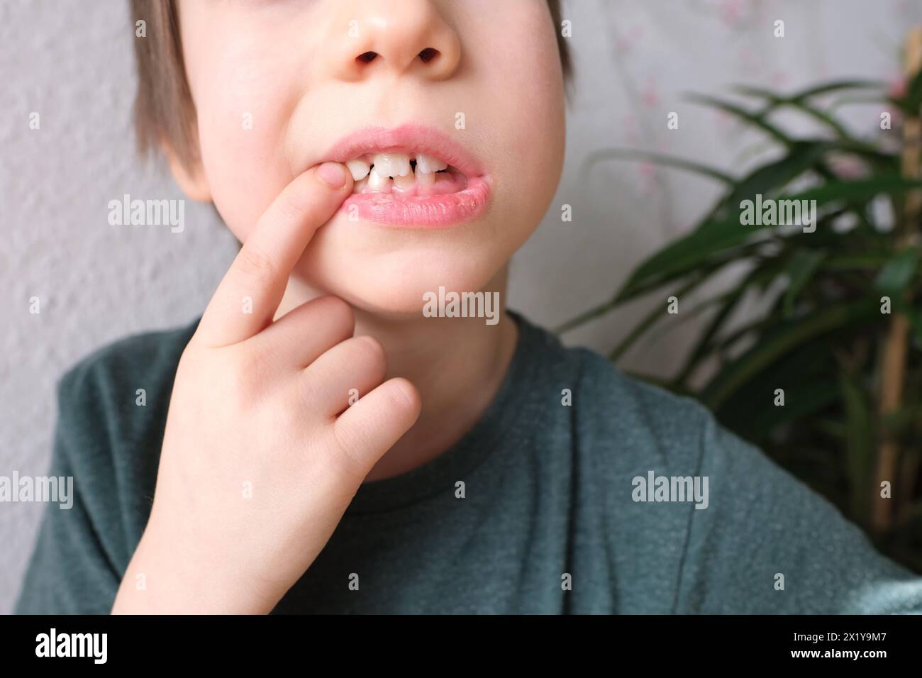 boy, kid nibbles and bites a nail on his hand, shows a disturbing tooth ...