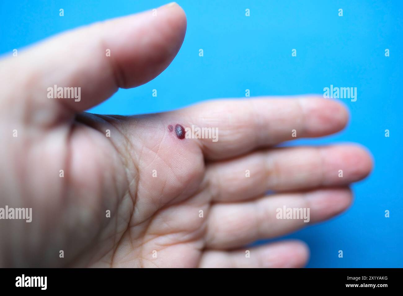 female hand with subcutaneous hemorrhage on the palm, trauma from ...