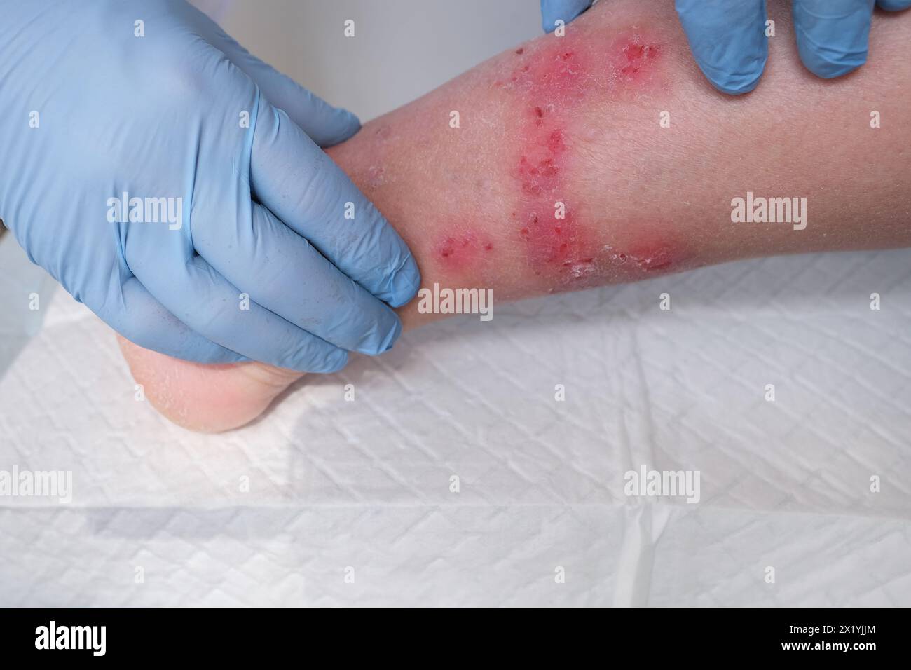 Sore shin hi-res stock photography and images - Alamy