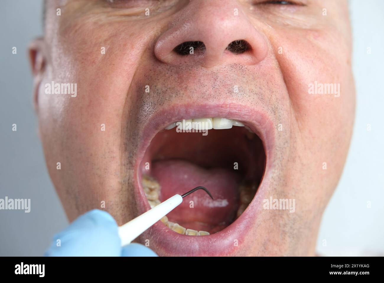 closeup male doctor conducts an examination of the oral cavity of an ...
