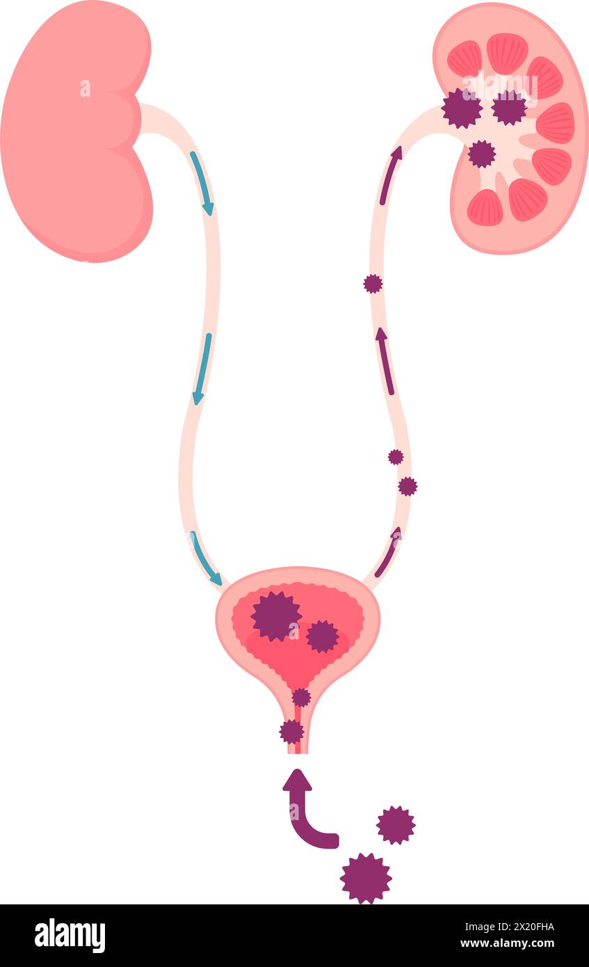 Urinary tract infection vector illustration Stock Vector Image & Art ...