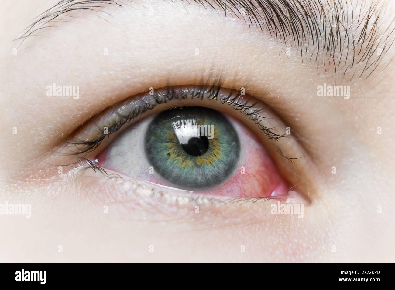 Close up of a severe bloodshot red eye. Viral Blepharitis ...