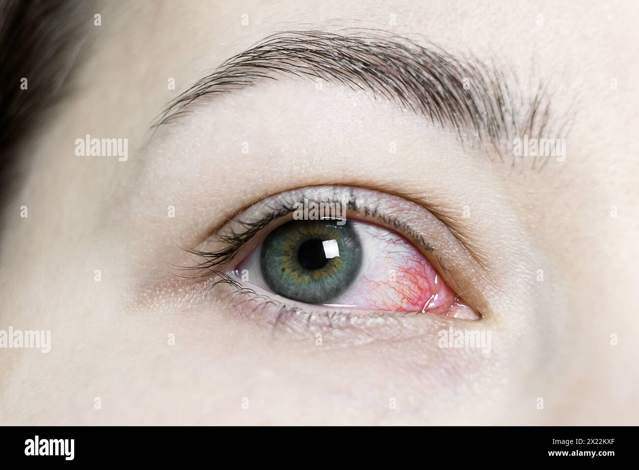 Close up of a severe bloodshot red eye. Viral Blepharitis ...